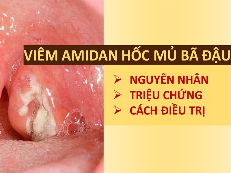 Viêm Amidan Hốc Mủ Bã Đậu - Đi Tìm Phương Pháp Điều Trị Tốt
