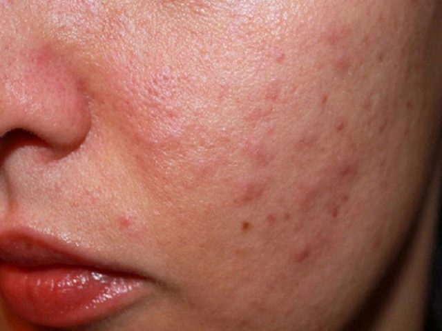 Viêm Da Mặt Nổi Mụn - Cách Điều Trị Phù Hợp Với Mọi Làn Da